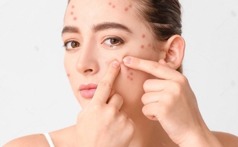 Is Fungal Acne Contagious? (Everything You Need To Know) - The Magazine ...